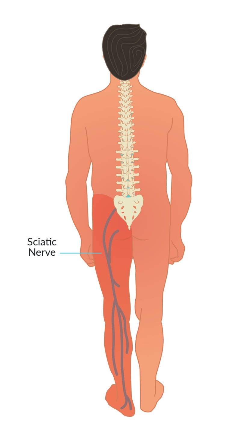 A Guide to Massage for Sciatica