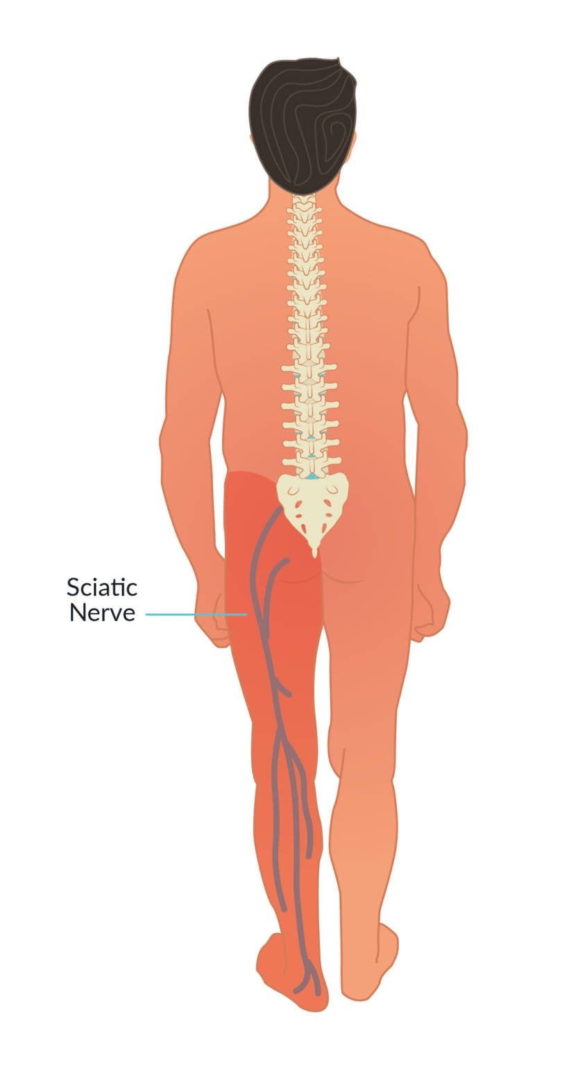 A Guide to Massage for Sciatica